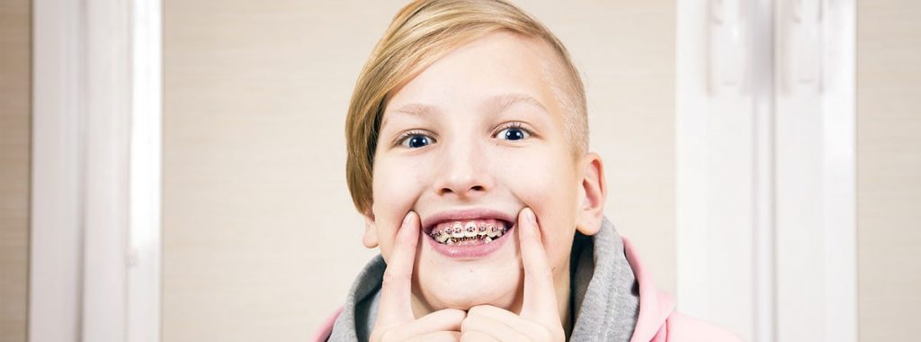 Does your Child Need Braces? - Barton Dental Surgery - Get Healthy ...