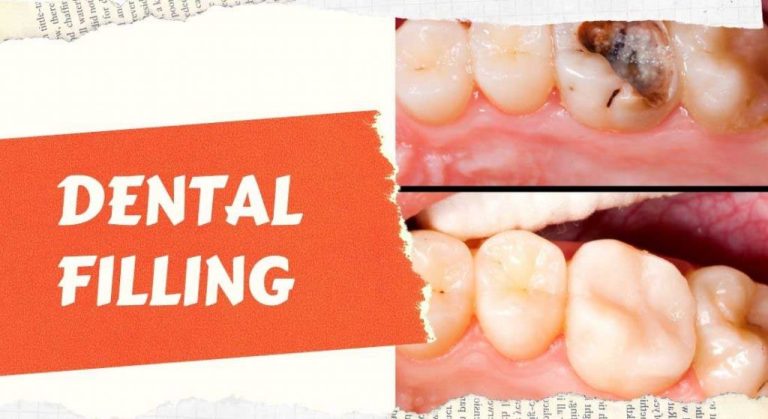 What Are the Different Types of Dental Fillings and How to Pick the ...